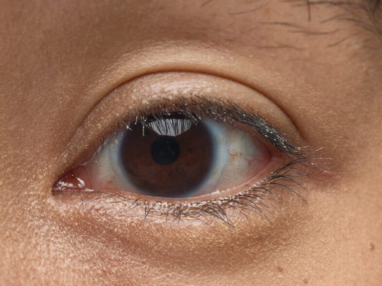 Let's Talk Demodex | Look at the Lids